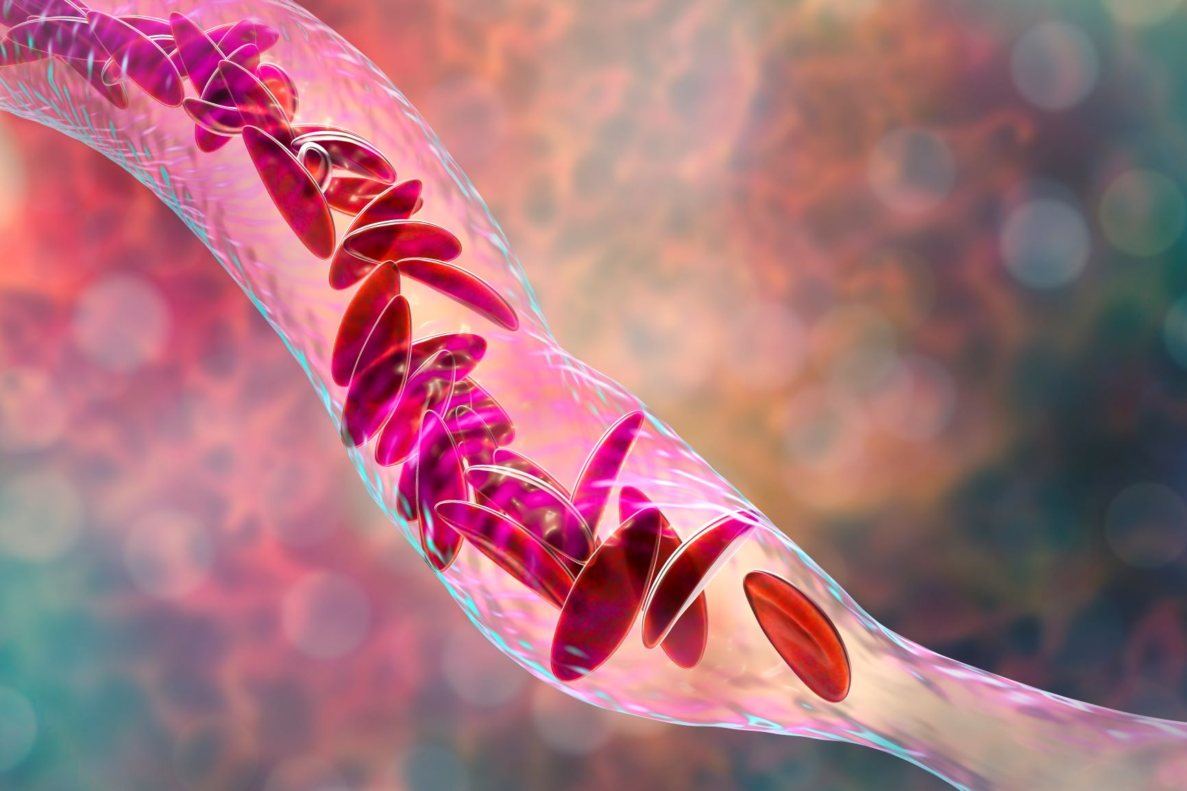 what-is-sickle-cell-disease-inspira-health